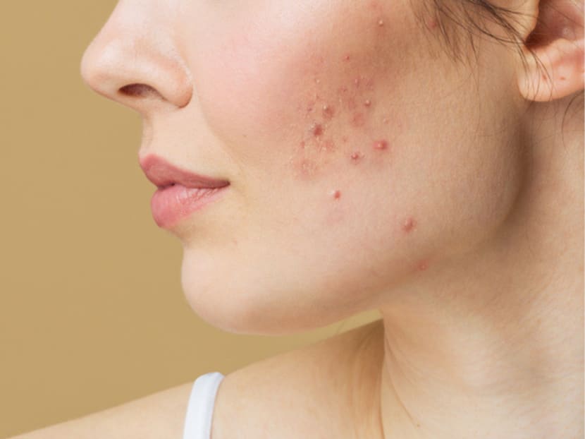 Why does having acne cause anxiety? - CNA Lifestyle