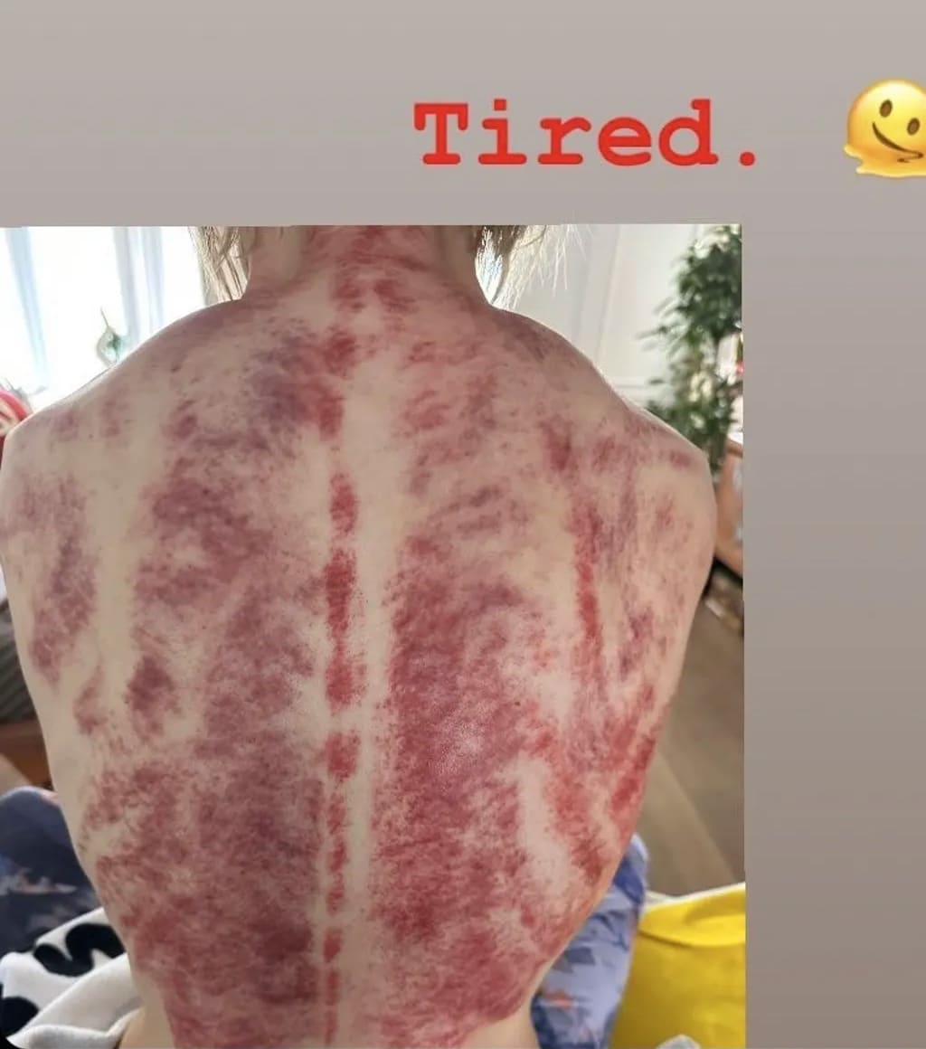 Sammi Cheng Posted A Pic Of Her Post-Gua Sha Back & It Looks Like A ...