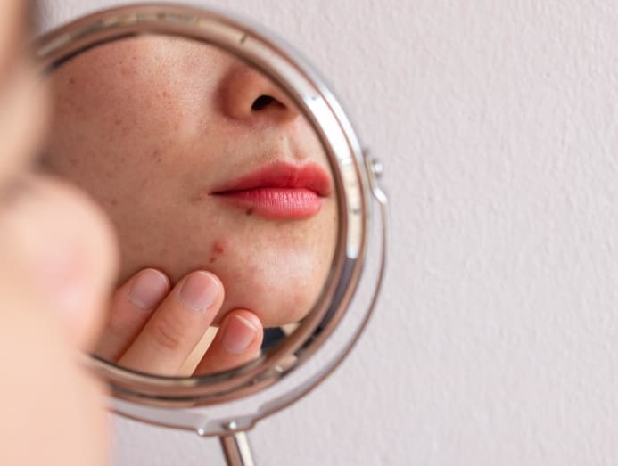 What is stress acne and how to deal with it - CNA Lifestyle