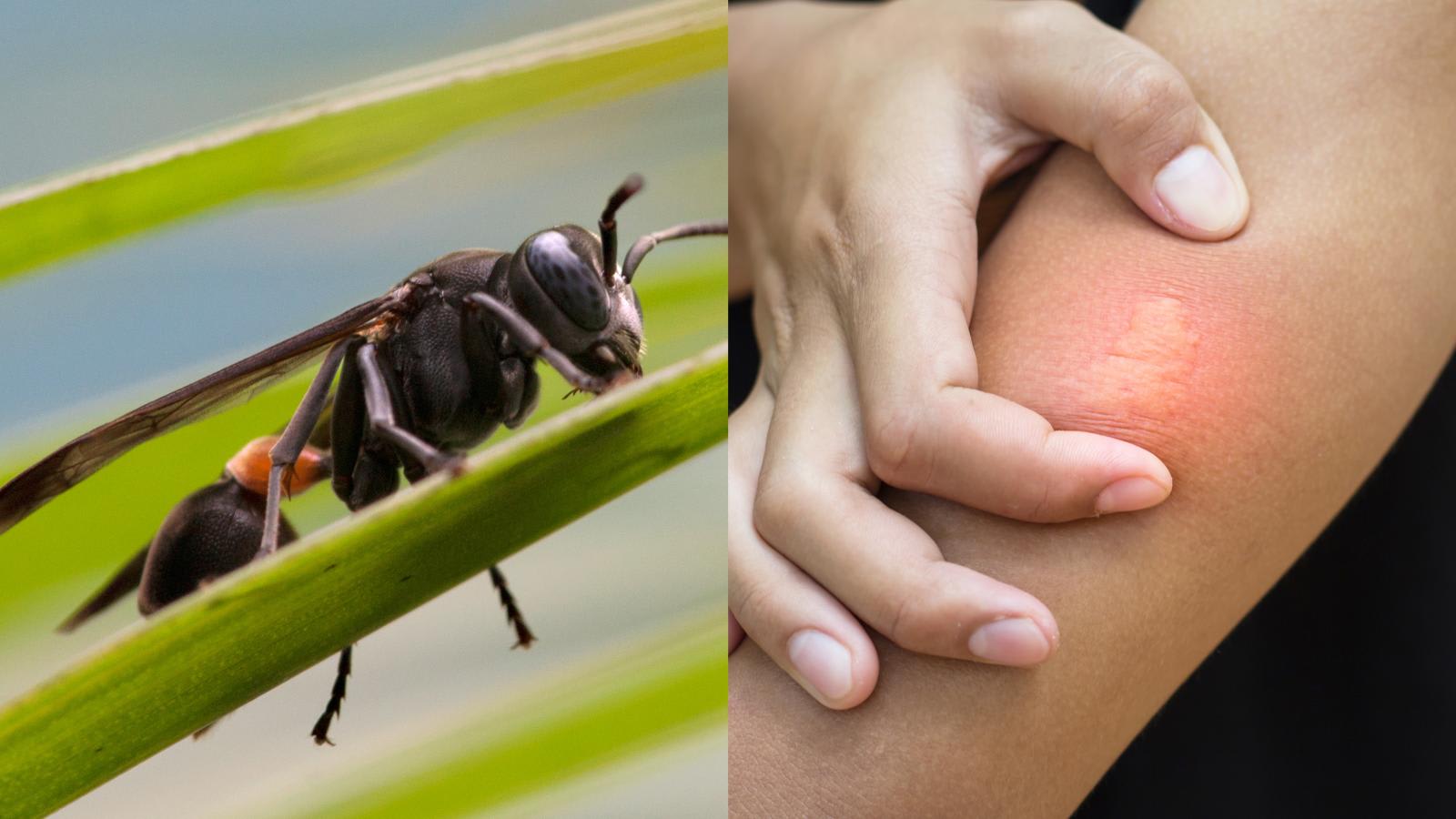 How to treat insect bites and stings from fire ants, hornets, bed bugs ...