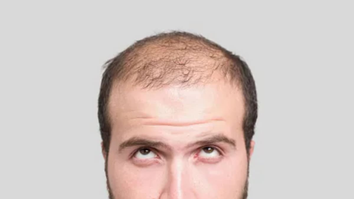 Botak tengah? Ini antara punca tidak diketahui ramai lelaki - BERITA ...