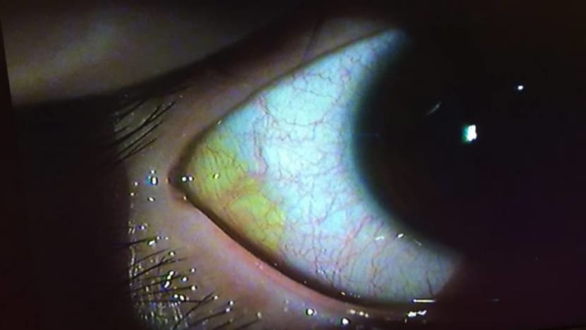 Cases of contact lenses stuck in eyes not that uncommon in Singapore ...