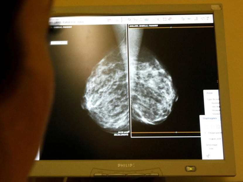Why early breast cancer detection truly saves lives - TODAY