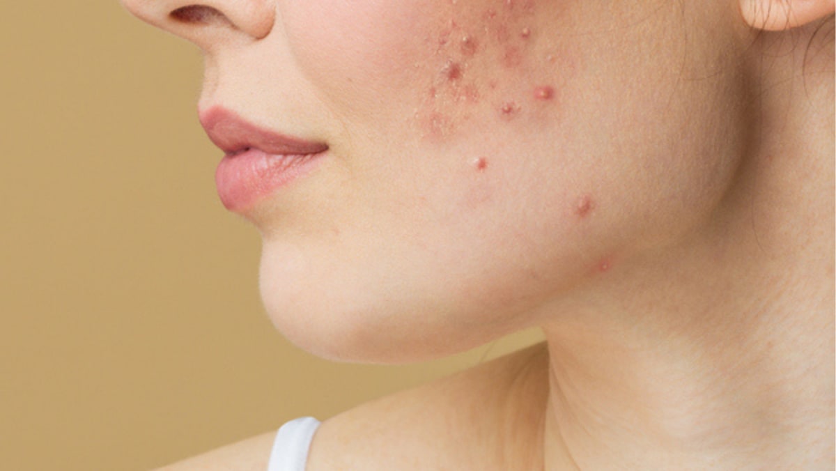 Why does having acne cause anxiety? - CNA Lifestyle