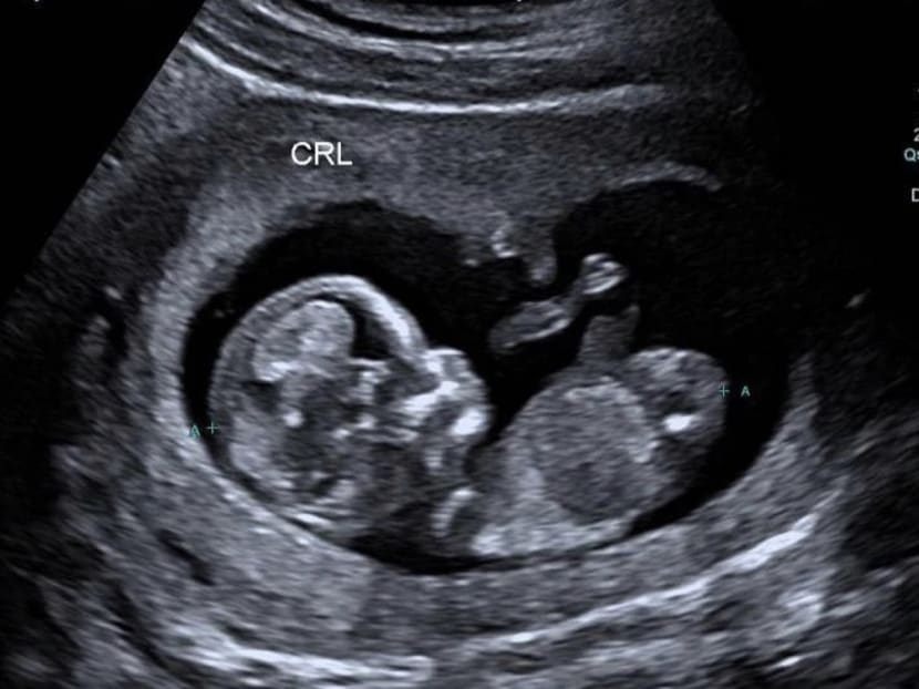 Joshua Ang Welcomes Daughter With New Partner 8 Months After Announcing ...