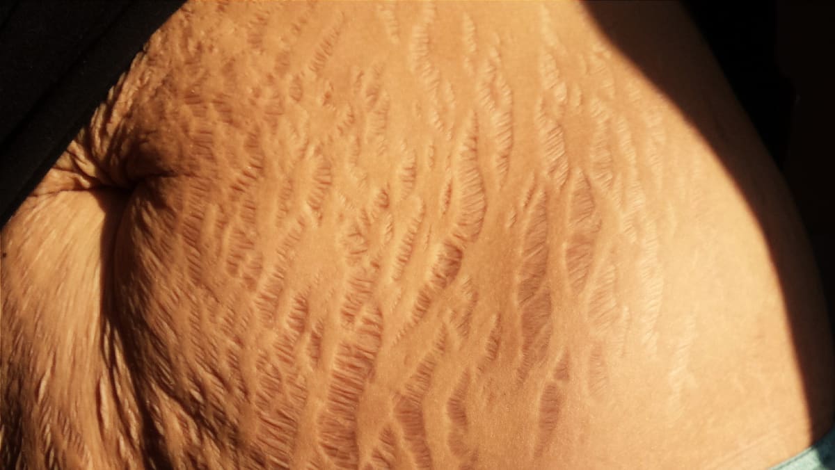Love Your Lines: Stretch marks go viral in support of women - TODAY