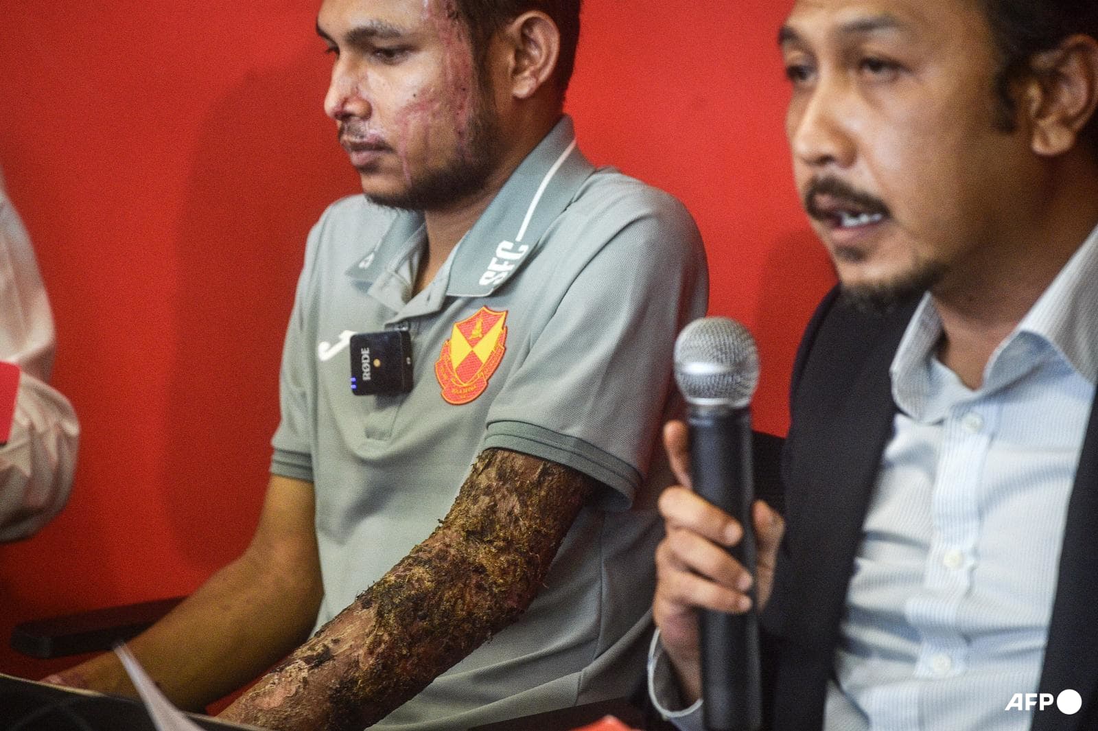 Malaysian footballer, Faisal Halim calls for justice after acid attack (photos)