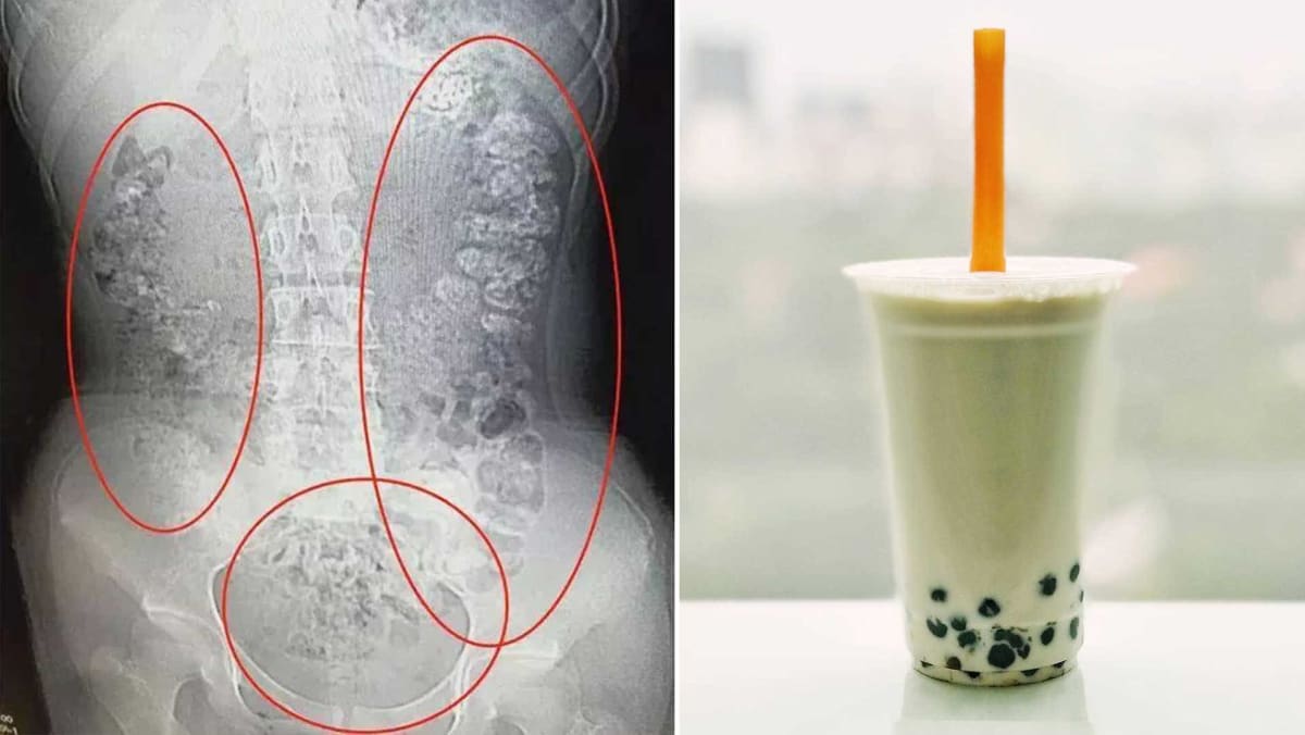Girl’s Viral X-ray Shows Undigested Bubble Tea Pearls That Are Actually ...