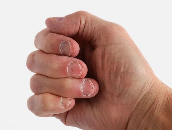 Bruised or ingrown toenail, broken fingernail – when should you see a ...