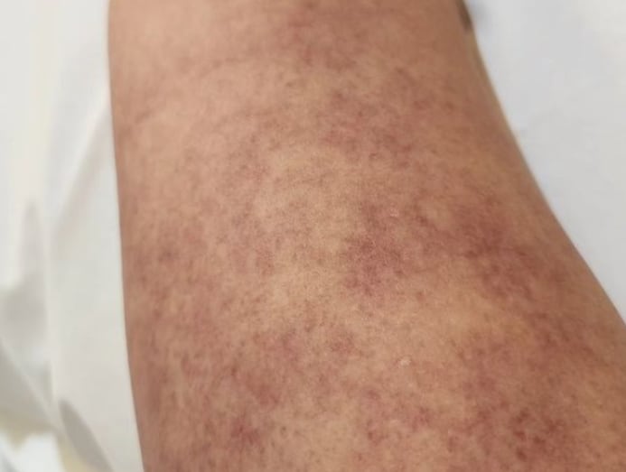 Actress Rui En reveals deep vein thrombosis scare, shows picture of ...