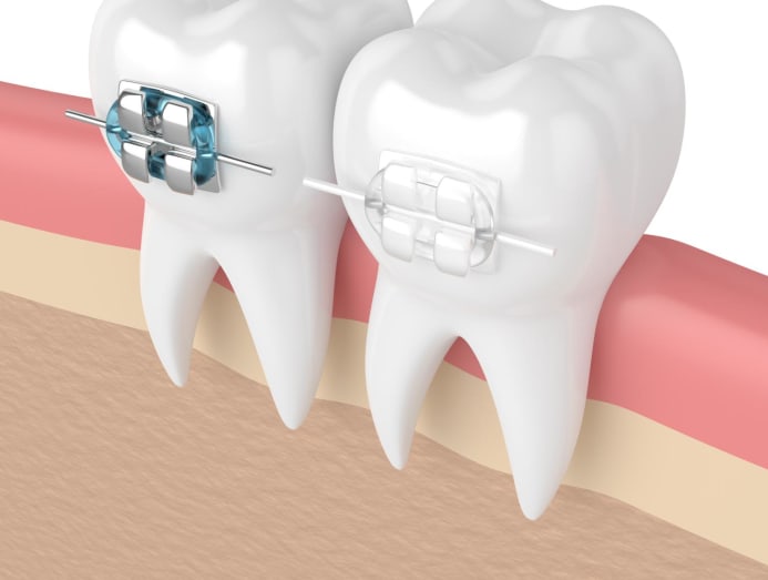 Invisalign, ceramic braces, metal braces: Teeth aligning options for ...