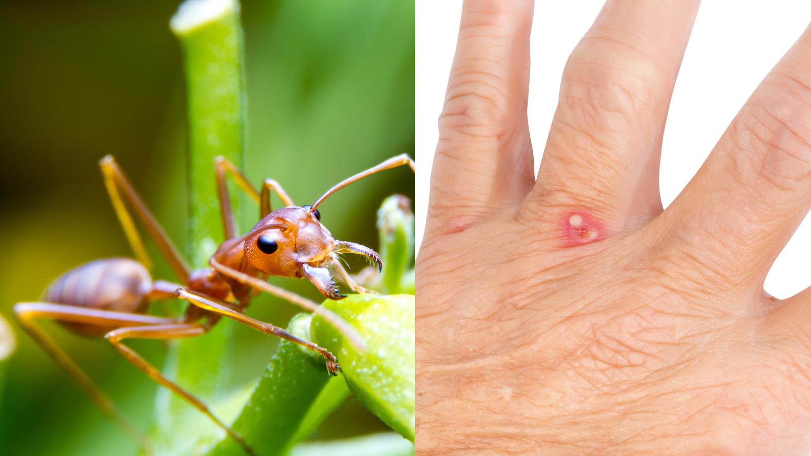 How to treat insect bites and stings from fire ants, hornets, bed bugs ...