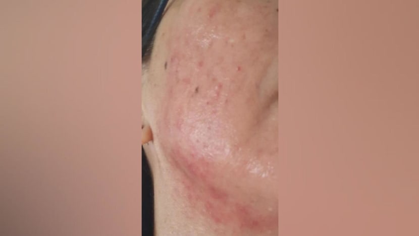 HSA warns against use of skin cream after woman developed severe ...