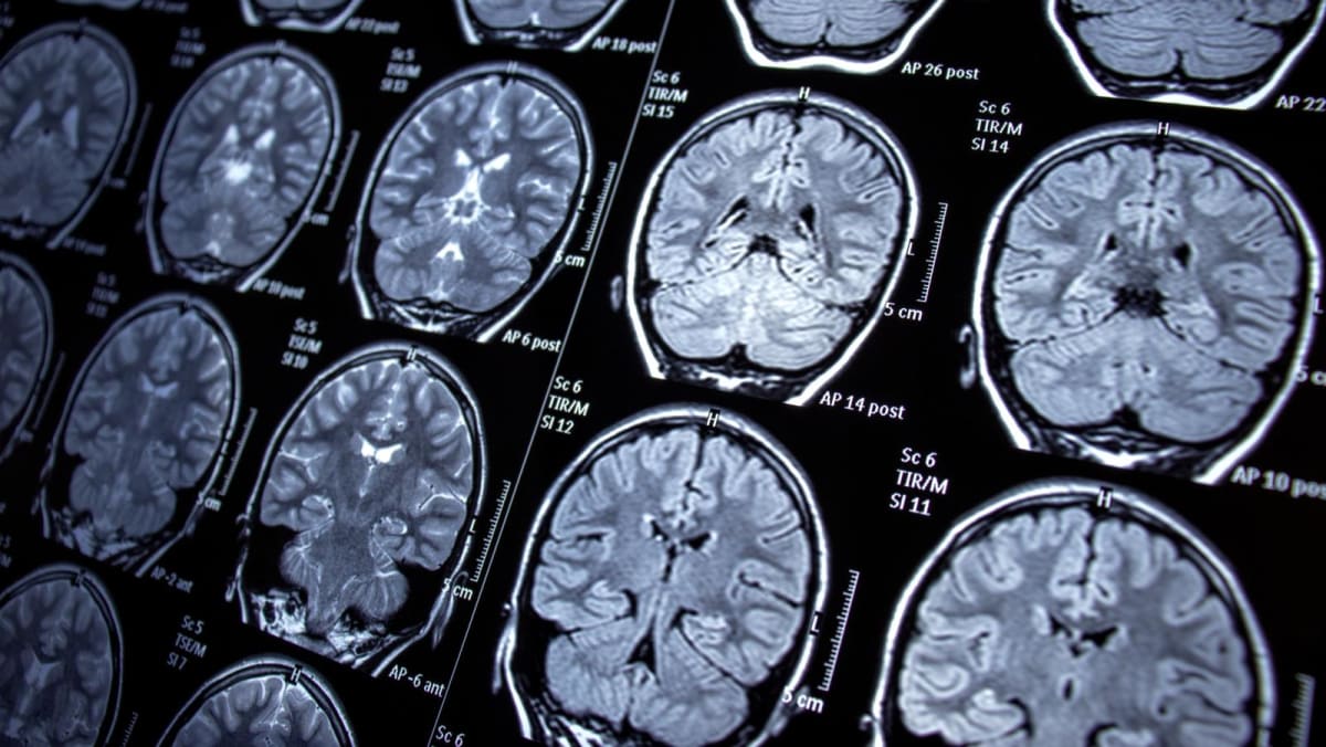 Commentary: The middle-aged brain changes a lot - and is key to ...