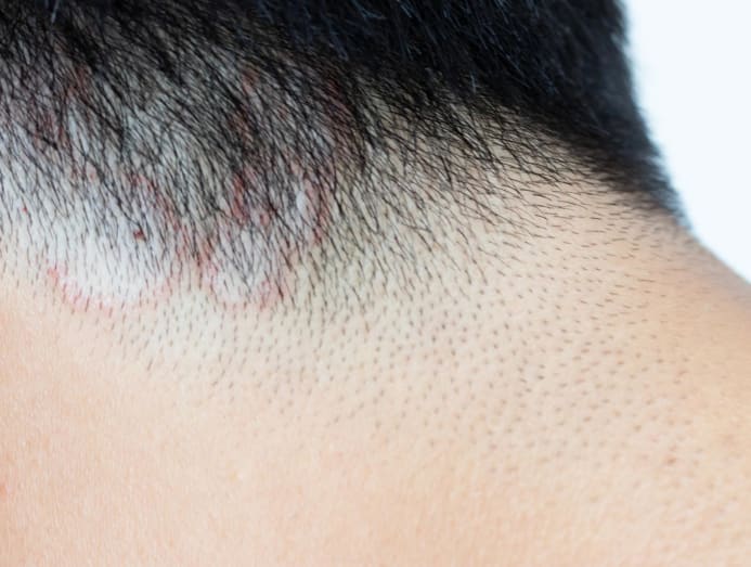 How to spot a fungal infection on skin, nails, scalp and elsewhere ...
