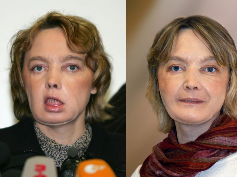 Woman who received world’s first face transplant dies - TODAY