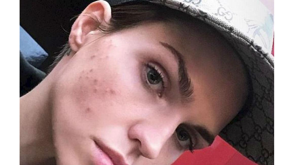 Ruby Rose's germ-infested phone gives her acne - 8 Days